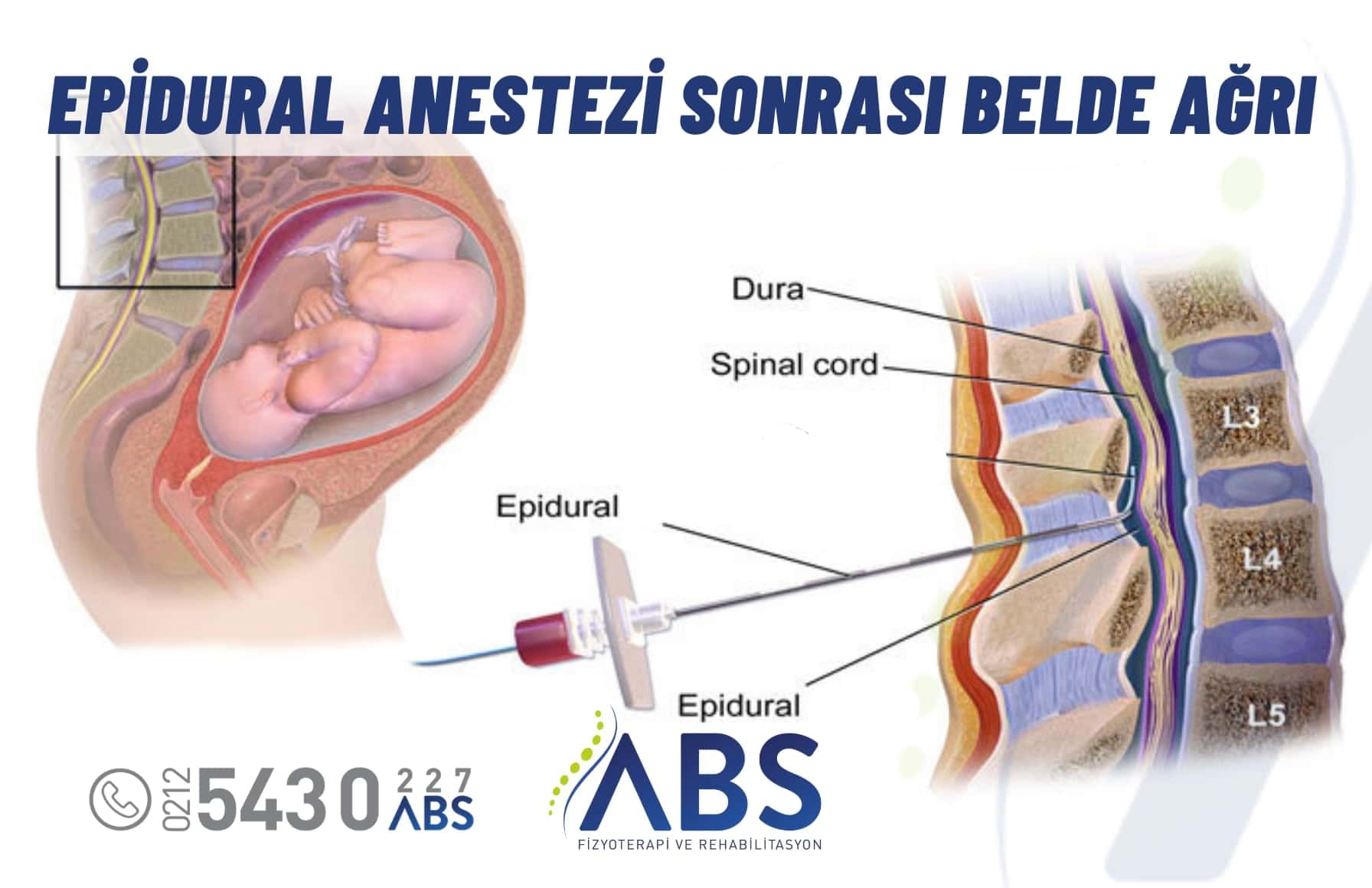 Epidural Anestezi Sonrası Belde Ağrı - A. Burak Sezgin